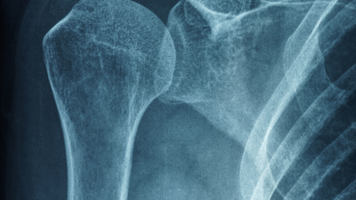 Actualité de la capsulite rétractile de l’épaule | SFR