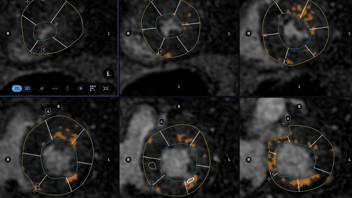 Quantification de la fibrose en IRM cardiaque | SFR