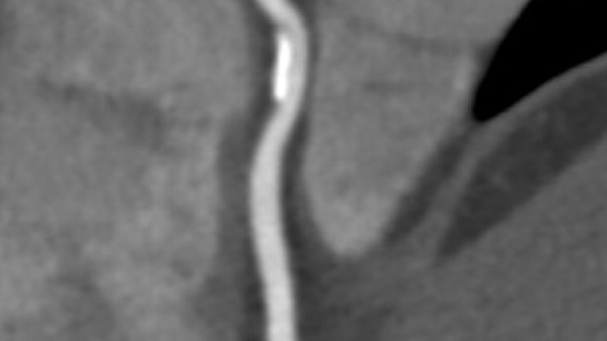 Caractérisation de la plaque athéromateuse en coro-scanner | SFR