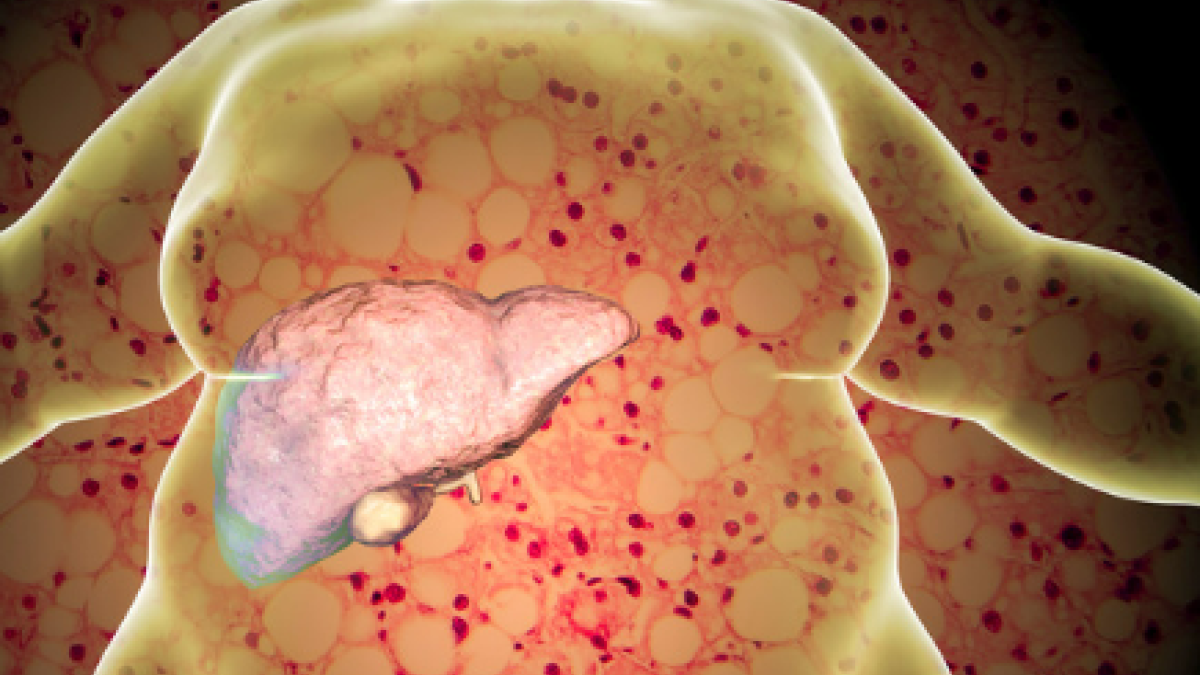 Stéatose hépatique - La catastrophe en marche | SFR