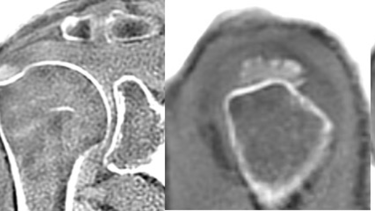 Nouvelle imagerie en IRM : les séquences CT-like !! | SFR