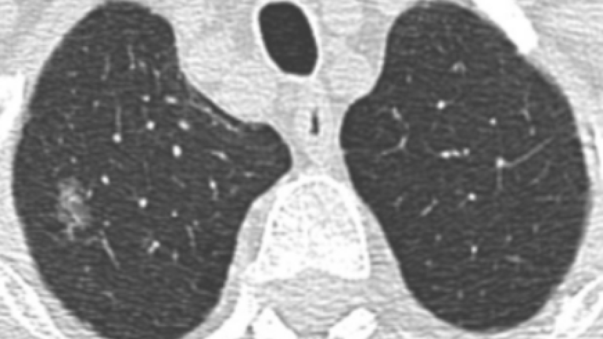 Nodules pulmonaires : trucs et astuces | SFR