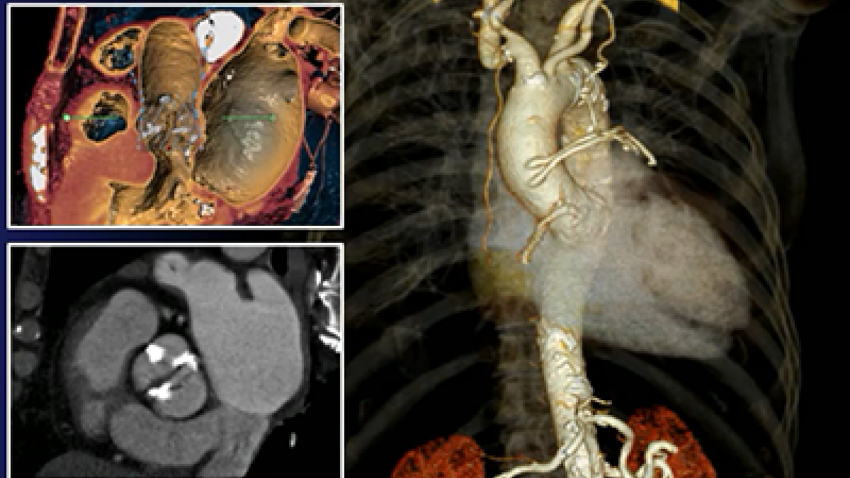 Le scanner cardiaque pour tous ! | SFR